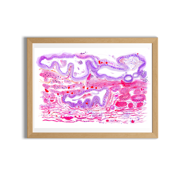 Chronic Cholecystitis Pathology Artwork - medpapers