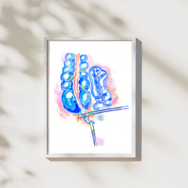 Laparoscopic Appendectomy General Surgery Art Print - medpapers