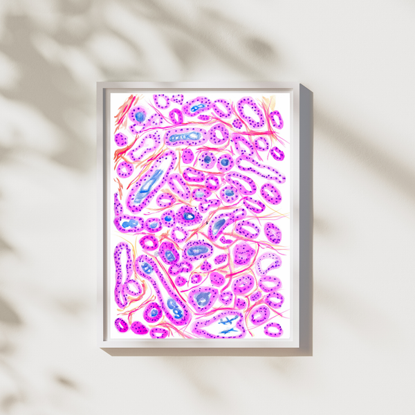 Prostate Adenocarcinoma Uropathology Art Print - medpapers