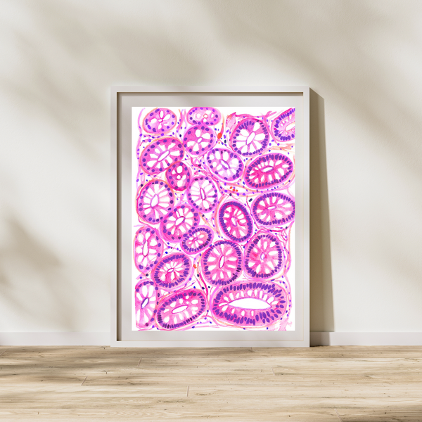 Colon Polyp - Tubular Adenoma Histopathology Art - medpapers