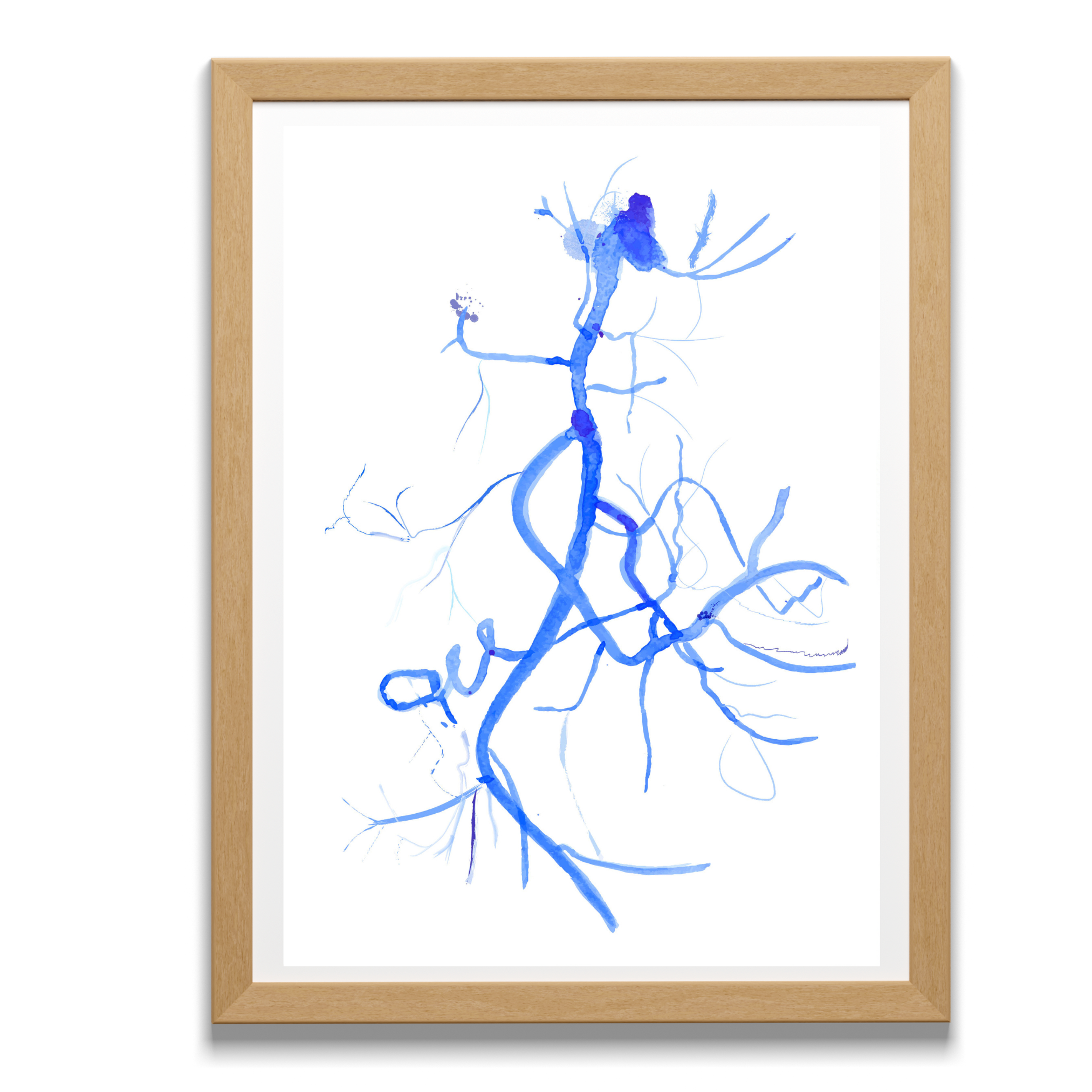 Radiology Art - DSA Internal Iliac Artery, Uterine Artery - medpapers