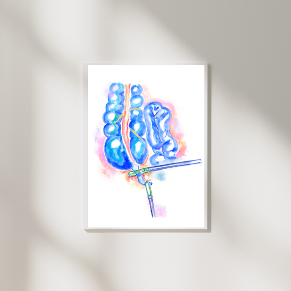 Laparoscopic Appendectomy General Surgery Art Print - medpapers