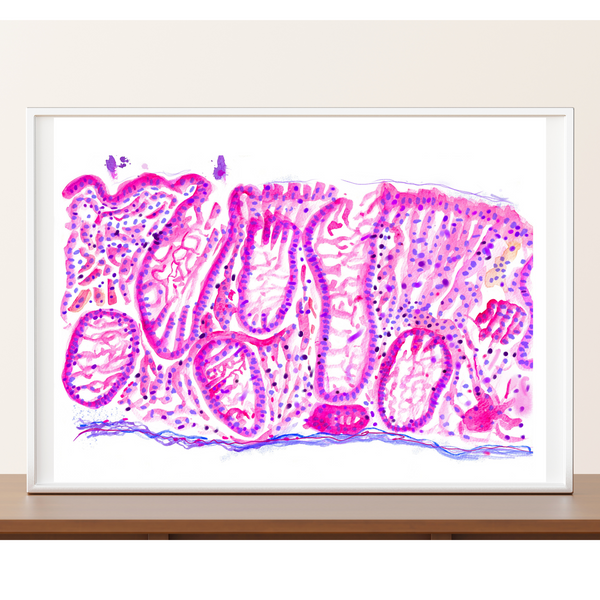Crohn´s Disease Histopathology Art Print - medpapers