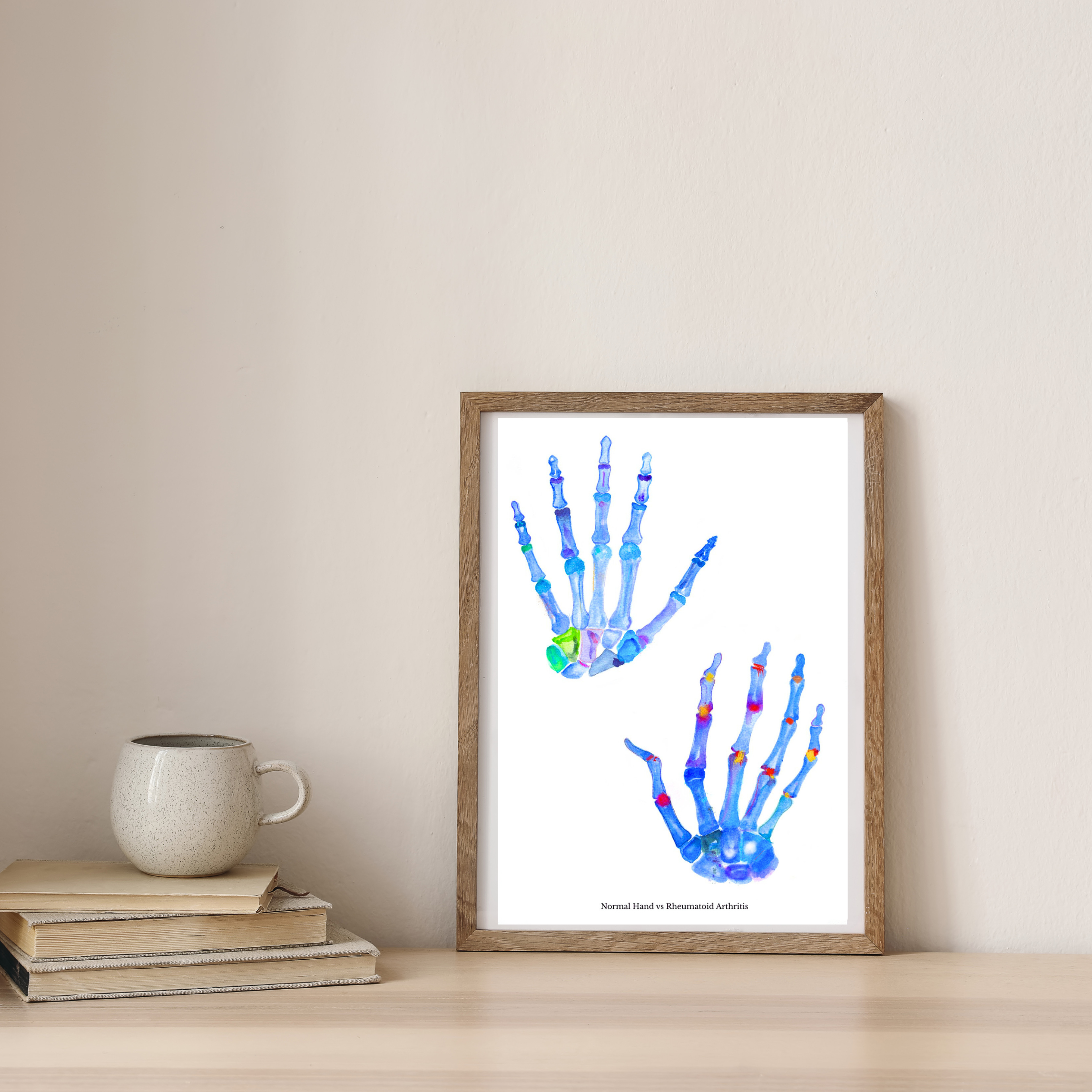 Rheumatoid Arthritis Hand Art - medpapers