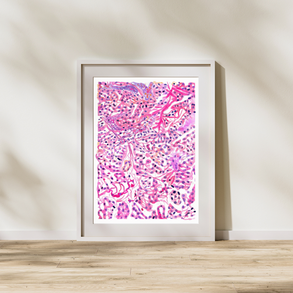 Solid Pseudopapillary Neoplasm Pancreas Watercolor Art Print - medpapers