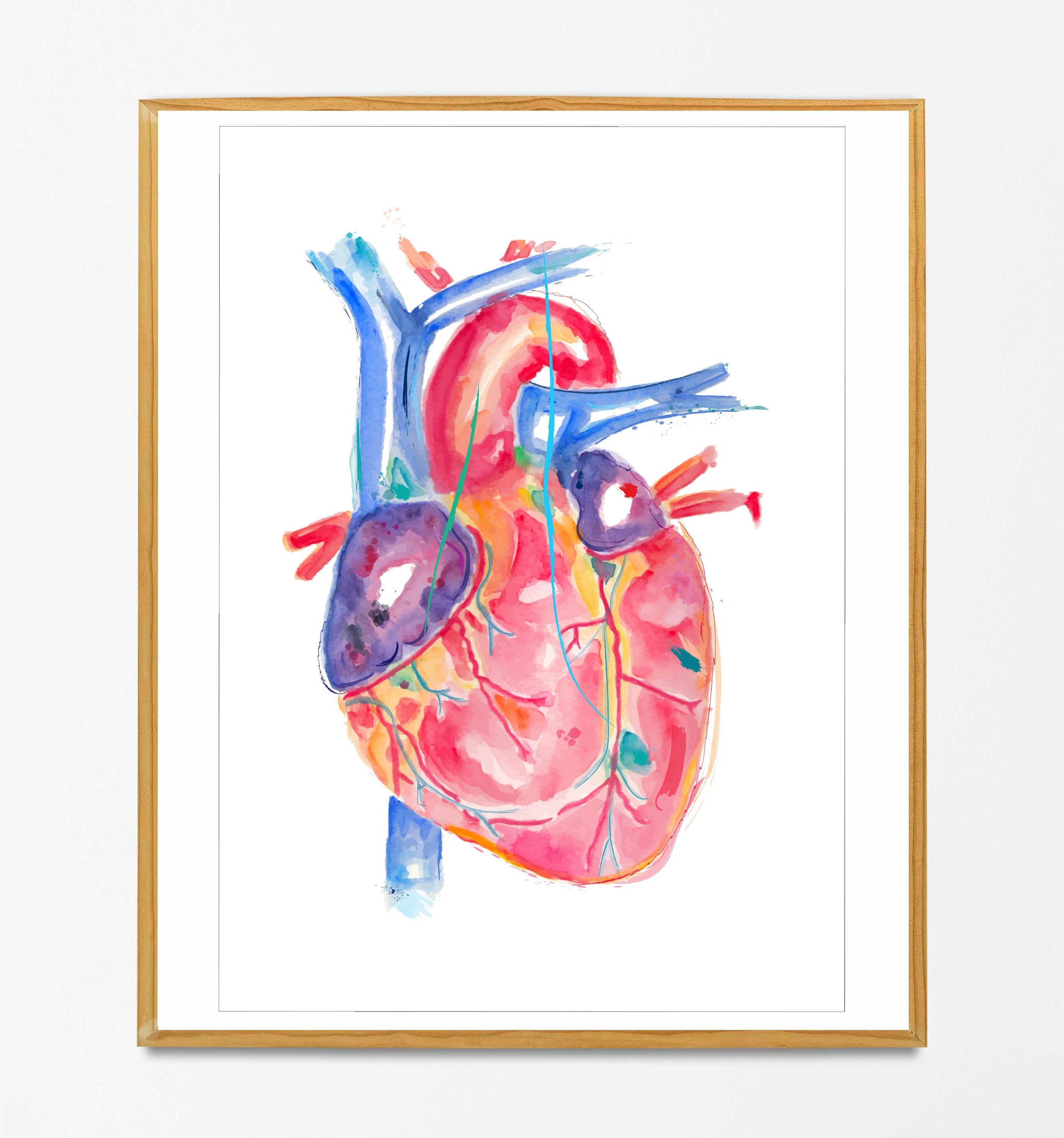 Coronary Artery Bypass Graft Surgery Art Print - medpapers