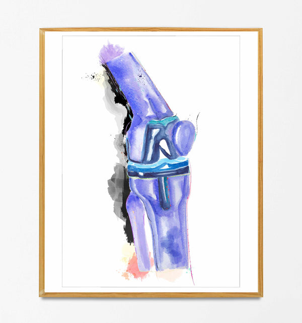 Knee Replacement Orthopedic Surgery Art Print - medpapers