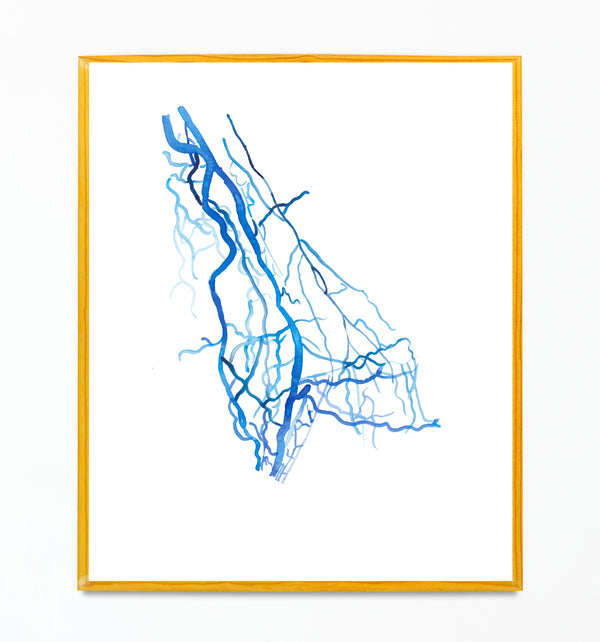 Upper Limb DSA, Vascular Surgery Radiology Art Print - medpapers