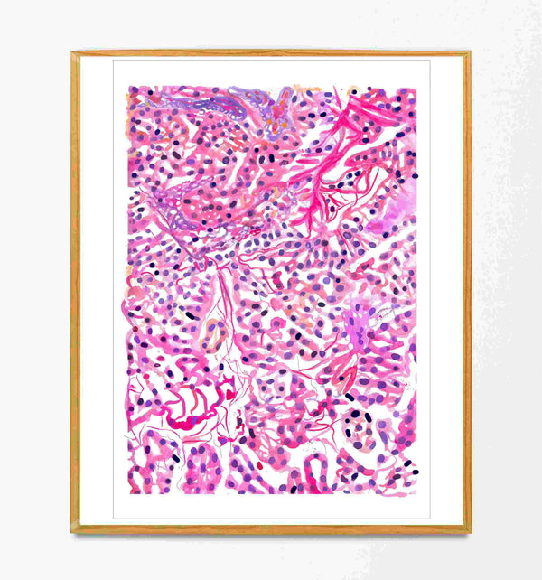 Solid Pseudopapillary Neoplasm Pancreas Watercolor Art Print - medpapers