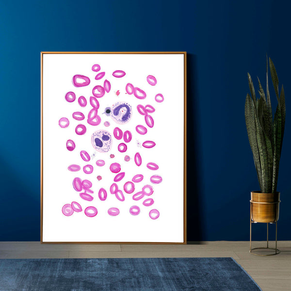 Sickle Cell Anaemia, Anemia Art, Hematology Art, Hematologist Gift, La ...